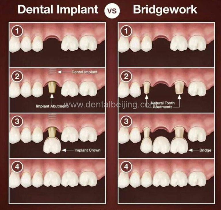 Dental Bridge vs Implant: Which One Should You Choose? - Beijing Keer ...